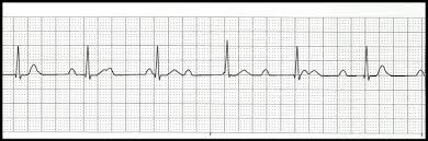 ACLS Rhythm Strips Quiz Test Questions and Answers