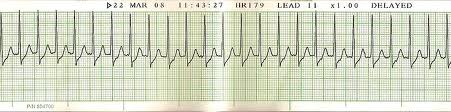 ACLS Rhythm Strips Quiz Test Questions and Answers