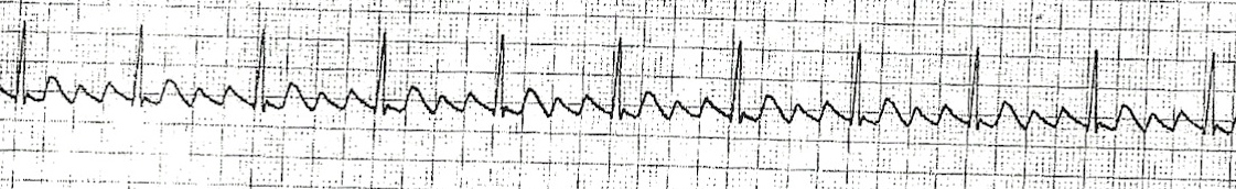 ECG Arrhythmia's - ProProfs Quiz