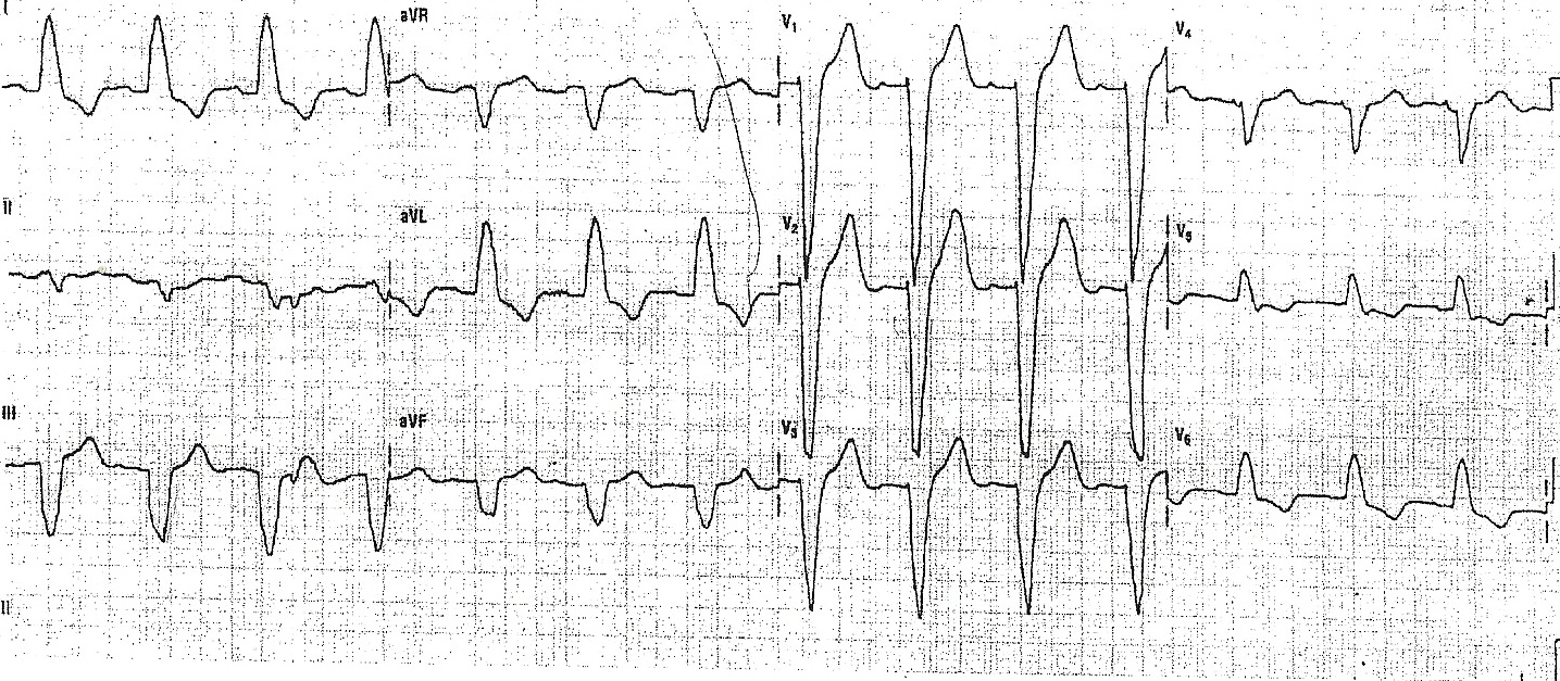 ECG Arrhythmia's - Quiz, Trivia & Questions