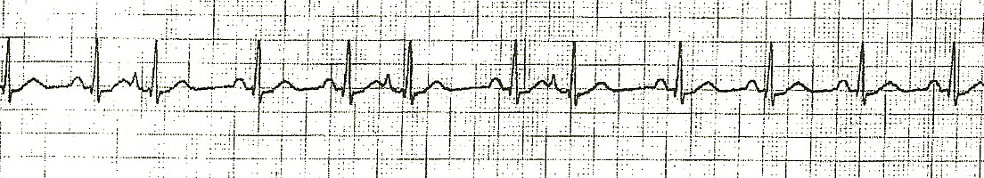 Irregular Heart Rhythm Strips