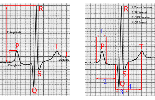 Cardiac Electrophysiology, Telemetry, And EKG Basics Stokke N180 - Quiz ...